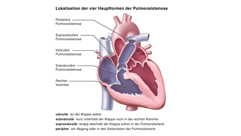 Pulmonalstenose: Die wichtigsten Fakten über den Herzklappenfehler ...